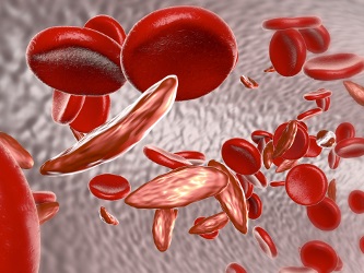 FDA Approves Endari for Sickle Cell Disease | American Pharmaceutical ...