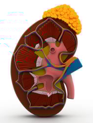 Jynarque Approved as First Treatment for Polycystic Kidney Disease ...