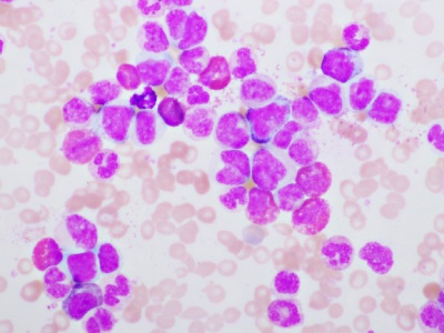 FDA Clears Biomea Fusion’s IND Application for Leukemia | American ...