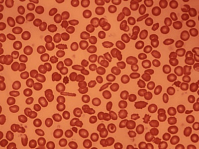 Approval of Devyser's RHD Product in Canada | American Pharmaceutical ...