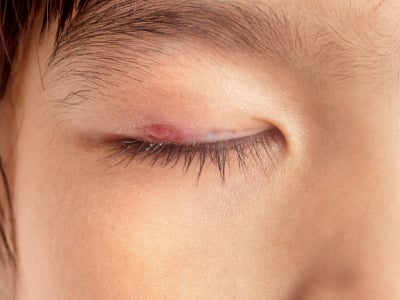 FDA Approves XDEMVY™ for the Treatment of Demodex Blepharitis ...