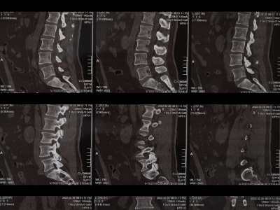 Biohaven's Taldefgrobep Alfa Receives EU Orphan Drug Designation for ...
