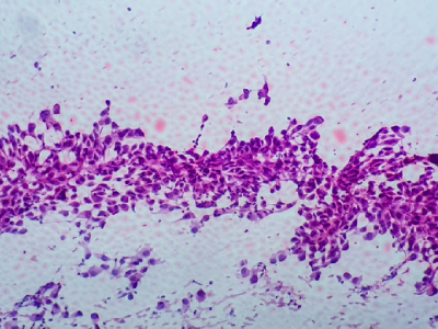 FDA Approves BMS’ Augtyro for the Treatment of Non-Small Cell Lung ...