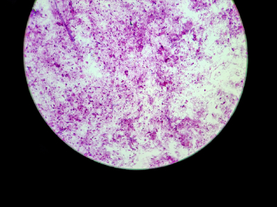 FDA Prioritizes Merck's KEYTRUDA® Plus Padcev® for Locally Advanced or ...