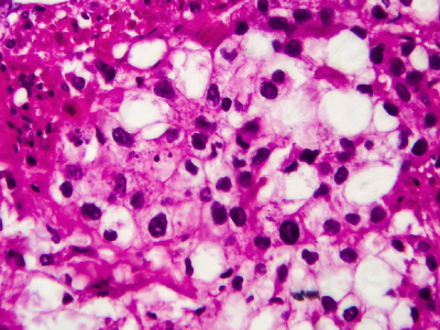 PADCEV® with KEYTRUDA® Approved by FDA to Treat Advanced Bladder Cancer ...