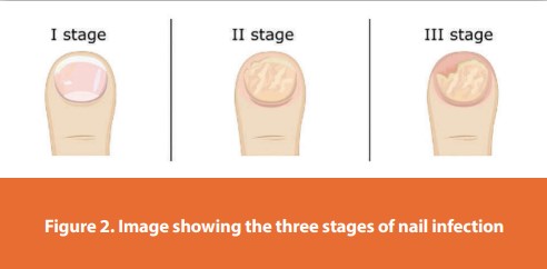 Your Nails and You | American Pharmaceutical Review - The Review of ...
