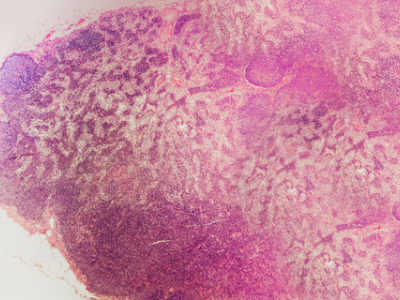 AbbVie Receives Positive CHMP Opinion for Epcoritamab (TEPKINLY®) for ...