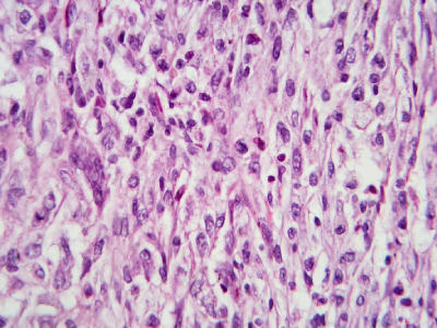 FDA Approves ROMVIMZA™ for the Treatment of Symptomatic Tenosynovial ...