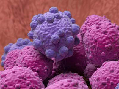 CHMP Recommends Calquence for Approval for Mantle Cell Lymphoma ...