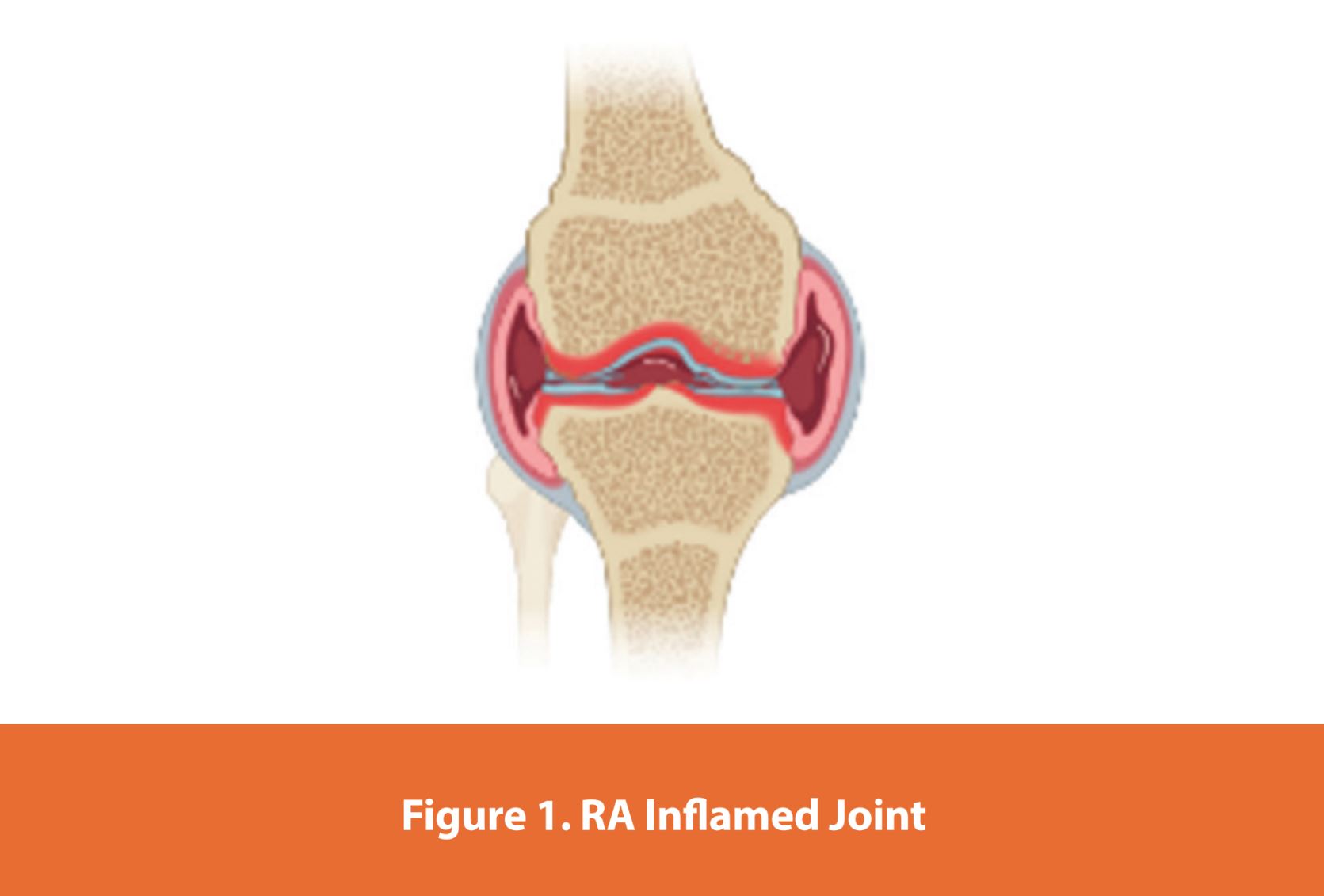 Novel Bioelectronic Medicine for Rheumatoid Arthritis: A Review ...