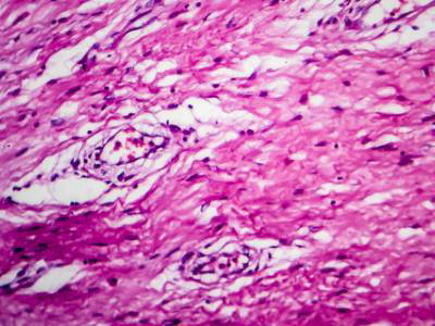 Merck’s Investigational Zilovertamab Vedotin Showed Promising Antitumor ...